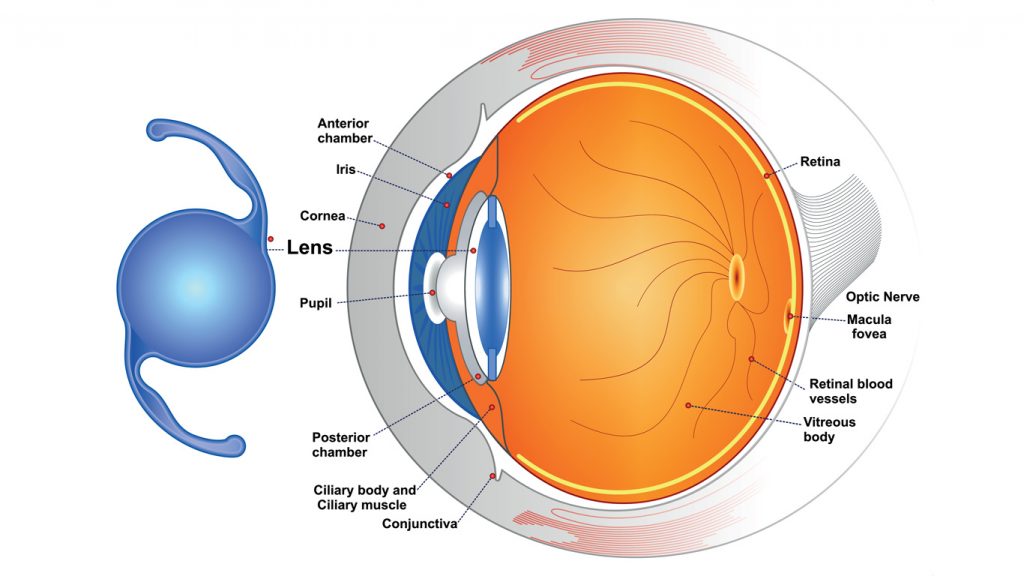How Intraocular Lens Can Help People with Cataract and Presbyopia ...