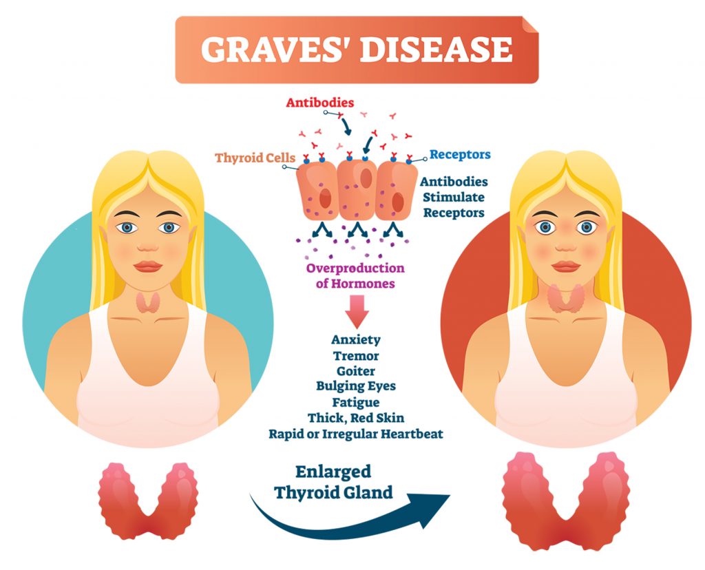 The Overactive Thyroid: What Happens When Your Body Won’t Slow Down ...