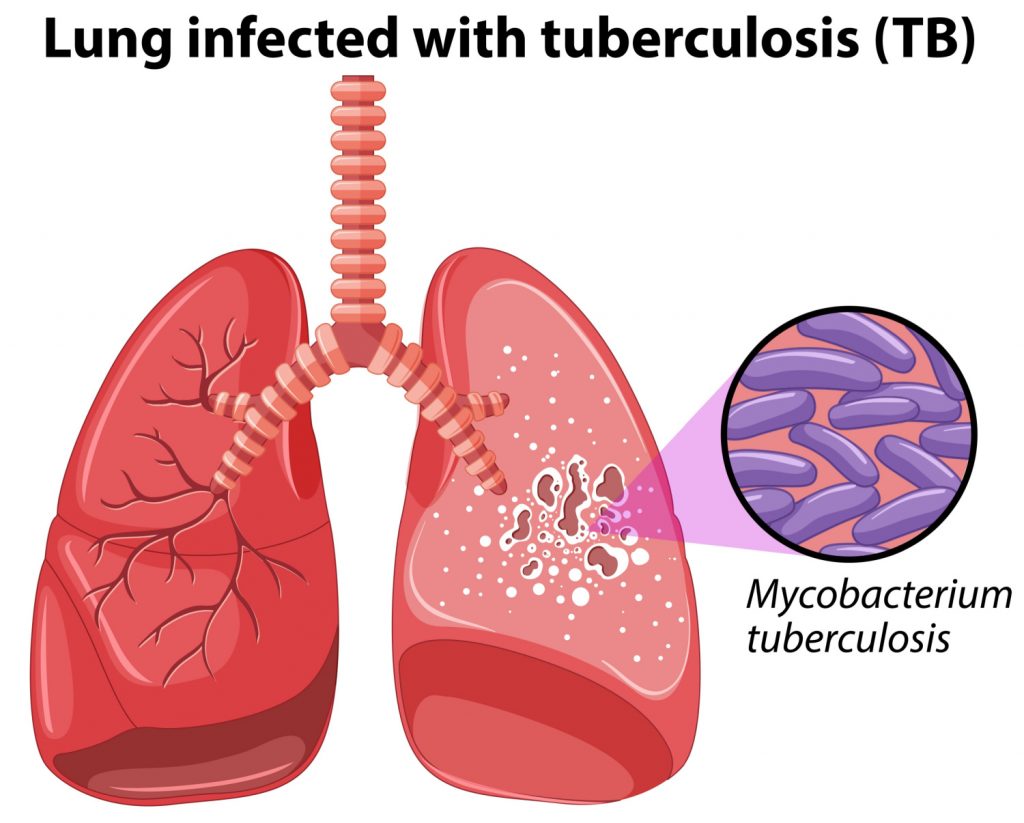 Tuberculosis Cases Are Rising in Malaysia. An Expert Shares What You ...
