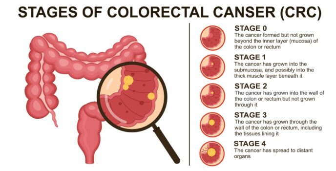 Is There Blood in Your Stool? This Simple at-Home Test Could Save Your ...