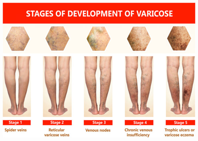 Struggling with Ugly Varicose Veins? Top Treatments You Need to Know ...