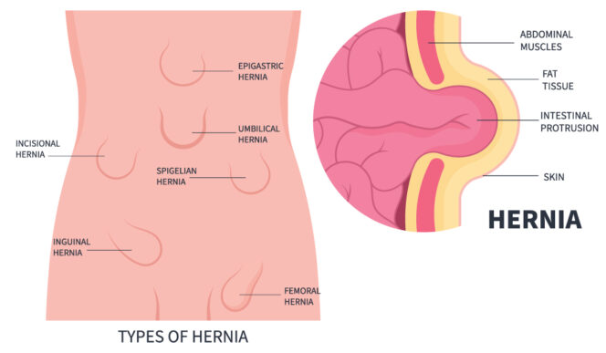 The Hernia Risk Every Man Needs to Know | HealthToday