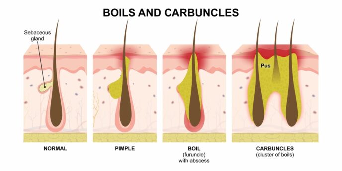 Is That a Boil on Your Skin? A Skin Specialist Explains What You Can Do ...